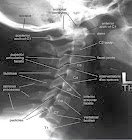 【芳澤徒手保健中心】淺談案例，讓您透過案例的說明來更了解徒手保健的意義::頸椎X光判讀
